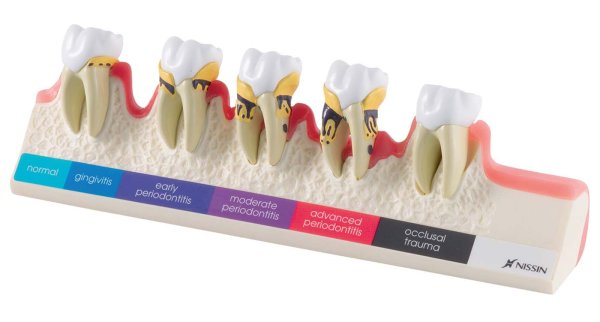 Demonstrationsmodell „Parodontose-Stadien“ P23-PD1 ...